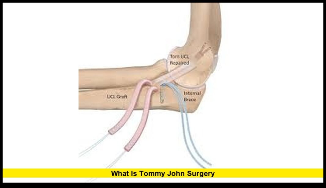 What Is Tommy John Surgery: A Complete Look at the Operation That ...