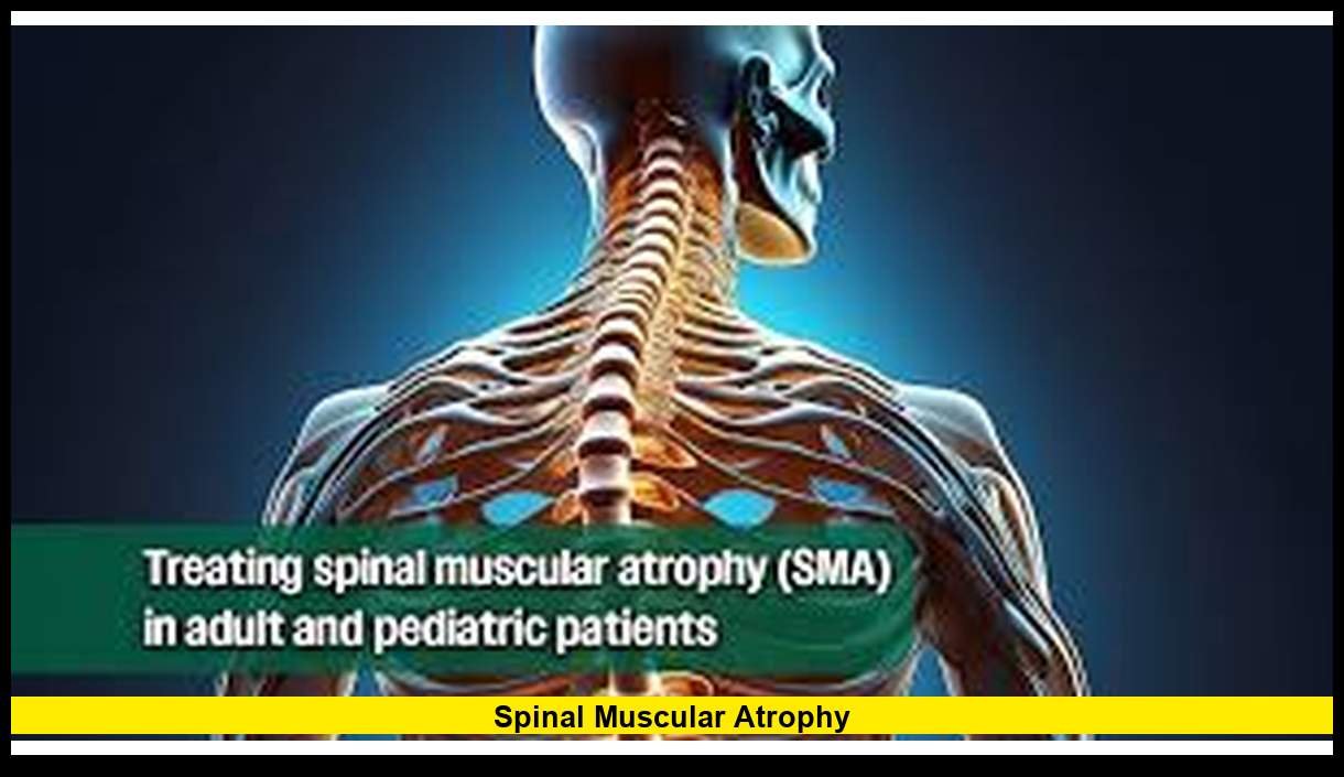 Spinal Muscular Atrophy: Current U.S. Developments, Care Advances, and ...